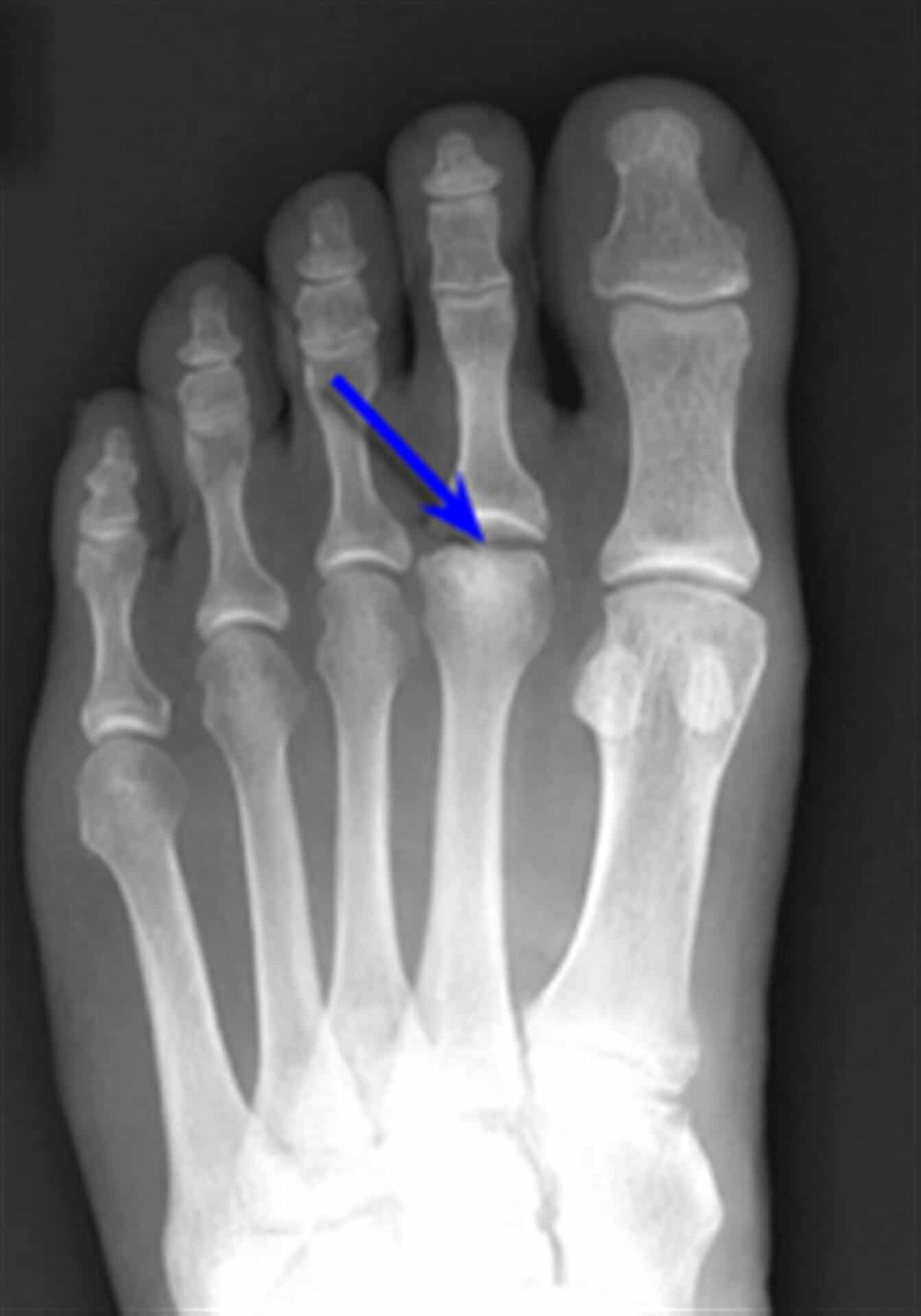 Freiberg s Infraction Avascular Necrosis Of The 2nd Metatarsal