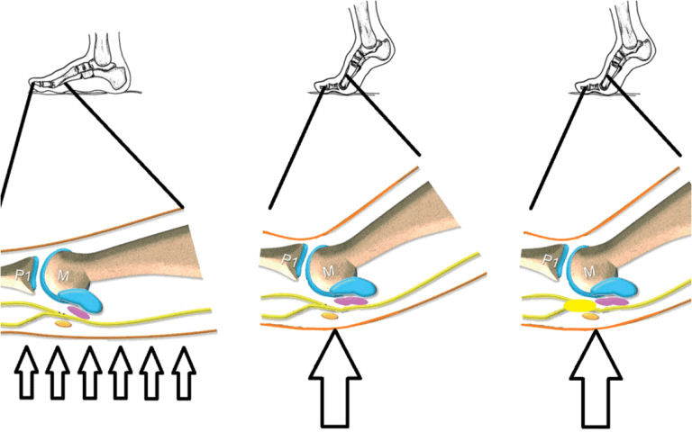 Intermetatarsal Bursitis - Ankle Foot and Orthotic Centre