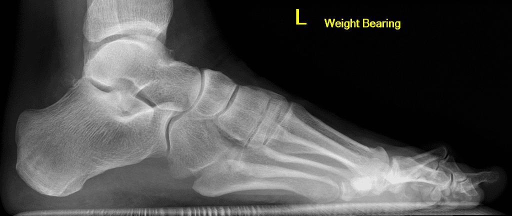 Midfoot Arthritis - Ankle Foot and Orthotic Centre