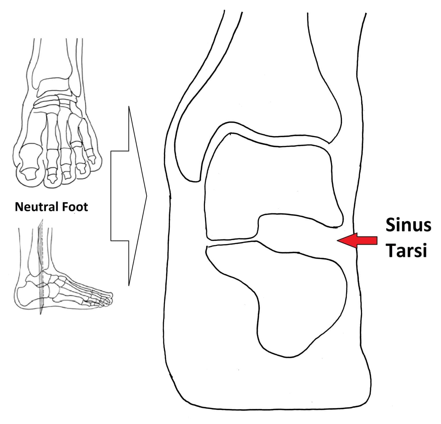 What is Sinus Tarsi Pain? Ankle and Foot Centre