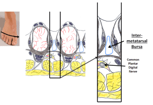 Intermetatarsal Bursitis - Ankle, Foot and Orthotic Centre