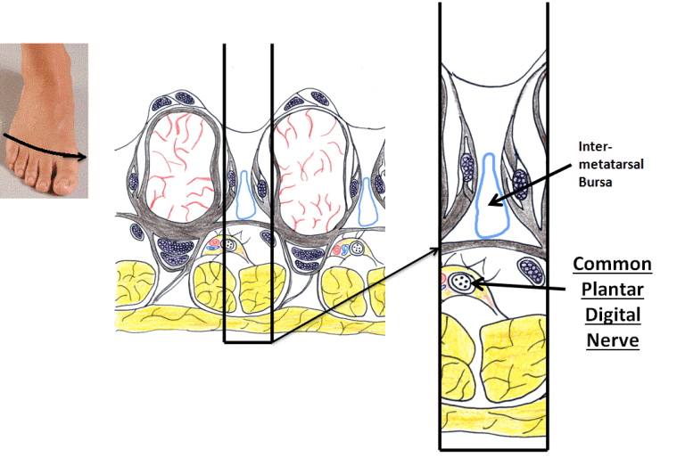 Bursal-Neuromal Complex vs Bursitis & Neuroma | AFOC