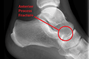 Anterior Calcaneus Avulsion Fracture Treatment | AFOC