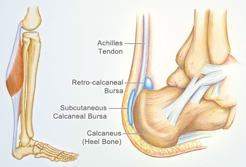 Subcutaneous Calcaneal Bursitis Ankle Foot And Orthotic Centre