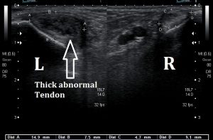 Posterior Tibial Tendon Dysfunction - Experts in Ankle Pain
