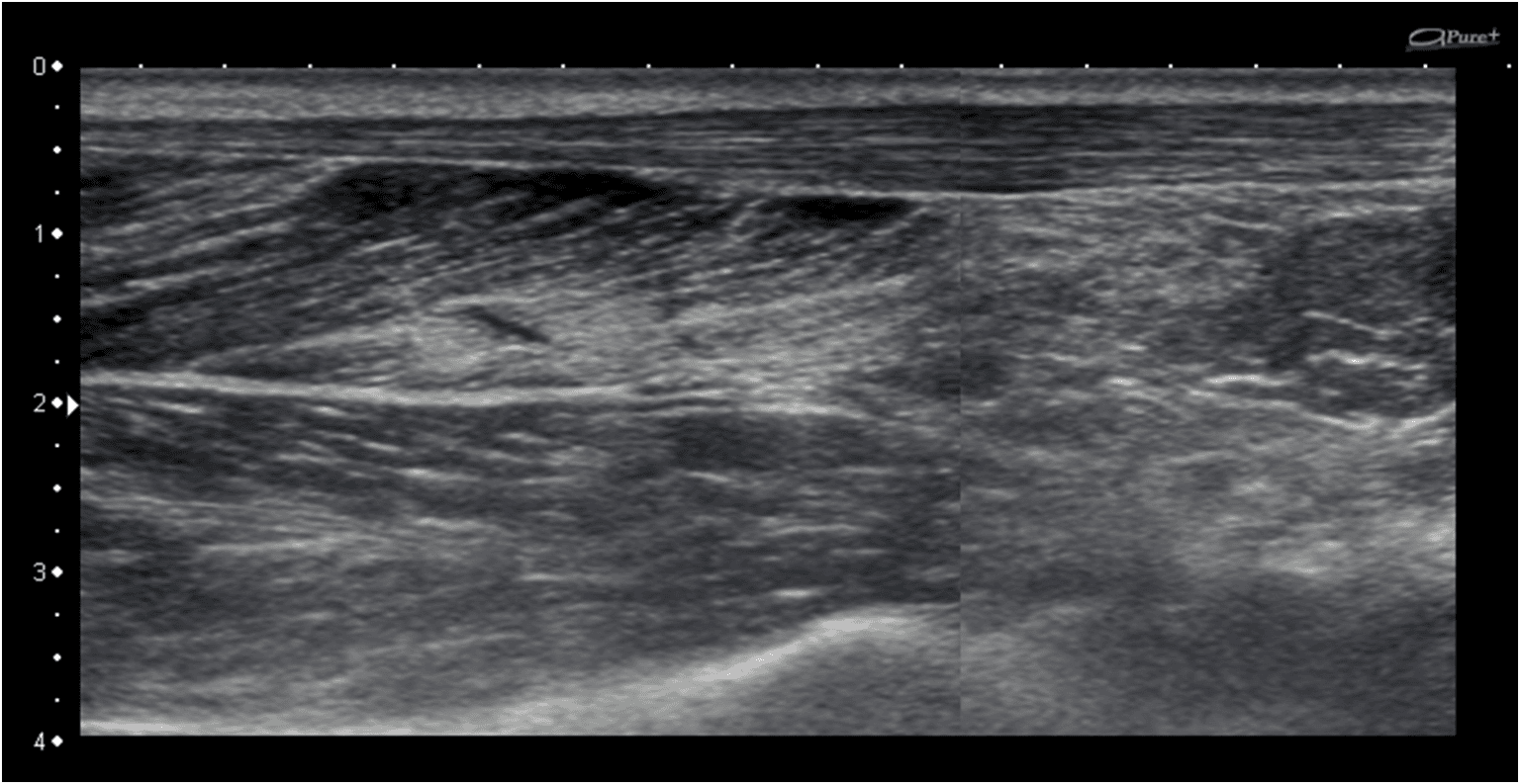 Ultrasound Images of Achilles Tendinopathy | AFOC