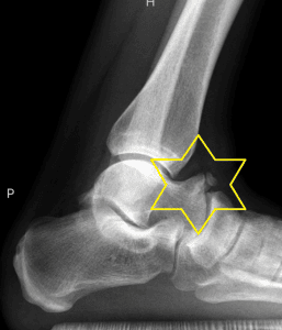 Anterior Ankle Impingement - Ankle, Foot and Orthotic Centre