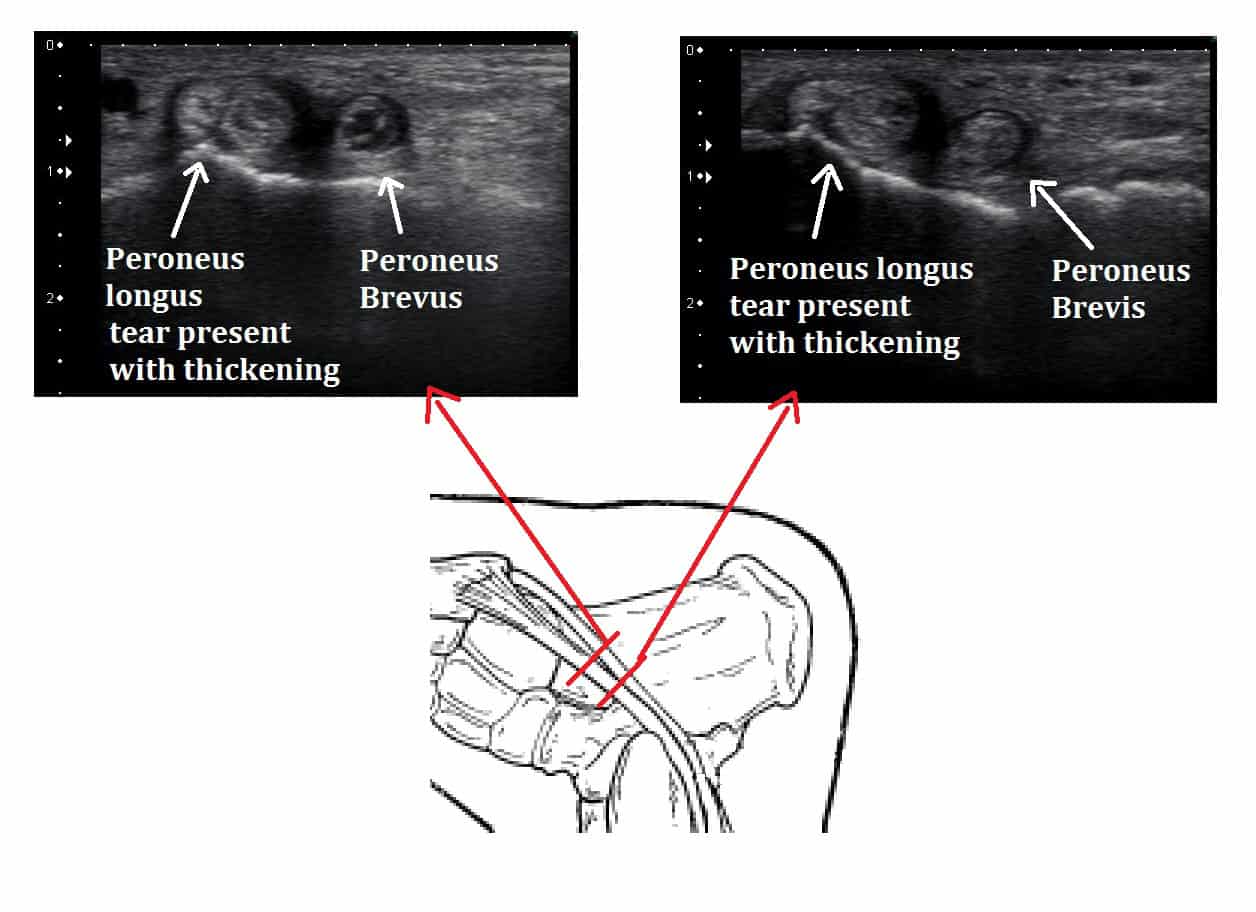 Peroneal Tendinopathy - Ankle, Foot and Orthotic Centre