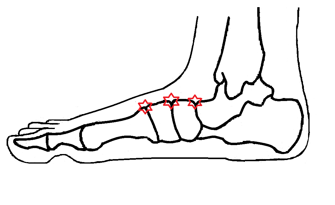 Dorsal Midfoot Compression - Ankle Foot and Orthotic Centre