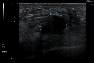Bursal-Neuromal Complex vs Bursitis & Neuroma | AFOC