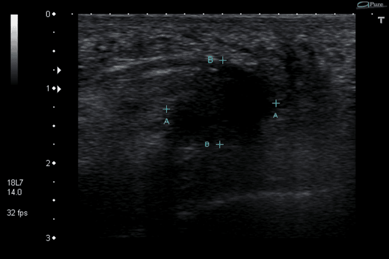 Bursal-Neuromal Complex vs Bursitis & Neuroma | AFOC