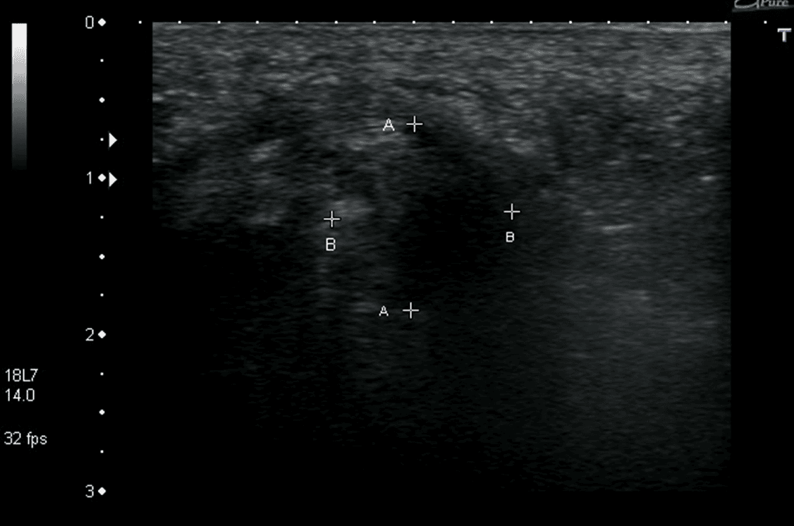 Bursal-Neuromal Complex vs Bursitis & Neuroma | AFOC