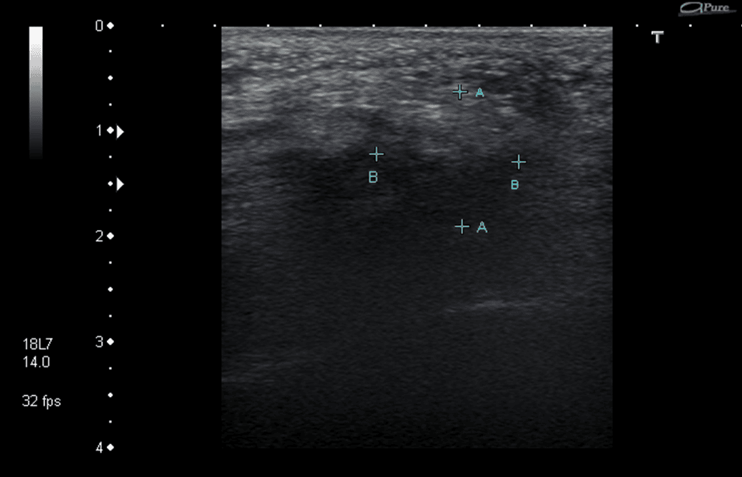 Bursal-Neuromal Complex vs Bursitis & Neuroma | AFOC