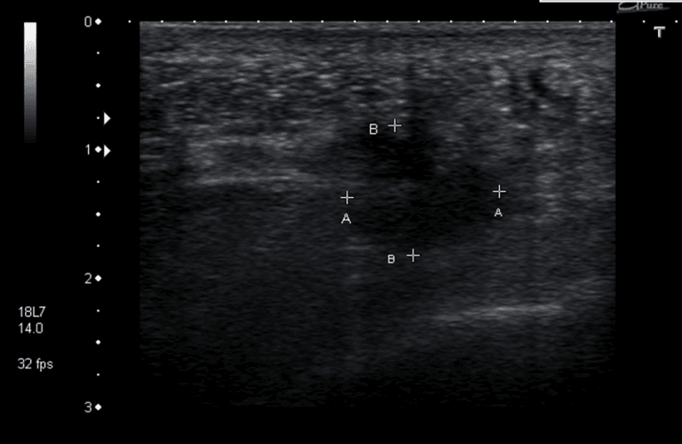 Bursal-Neuromal Complex vs Bursitis & Neuroma | AFOC