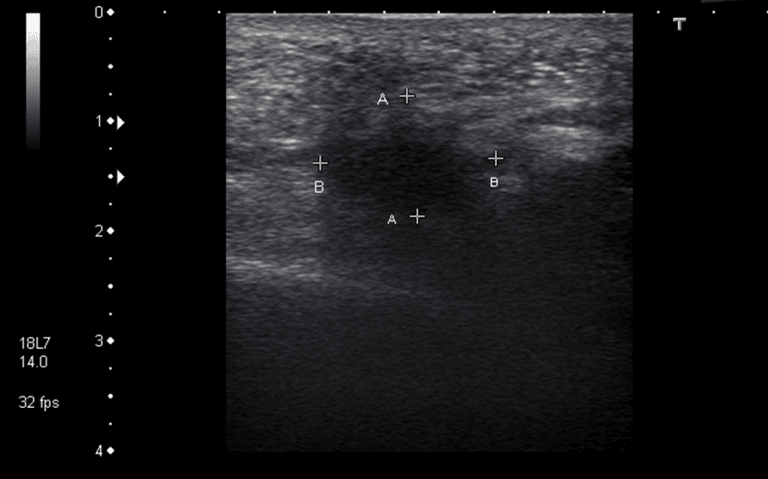 Bursal-Neuromal Complex vs Bursitis & Neuroma | AFOC