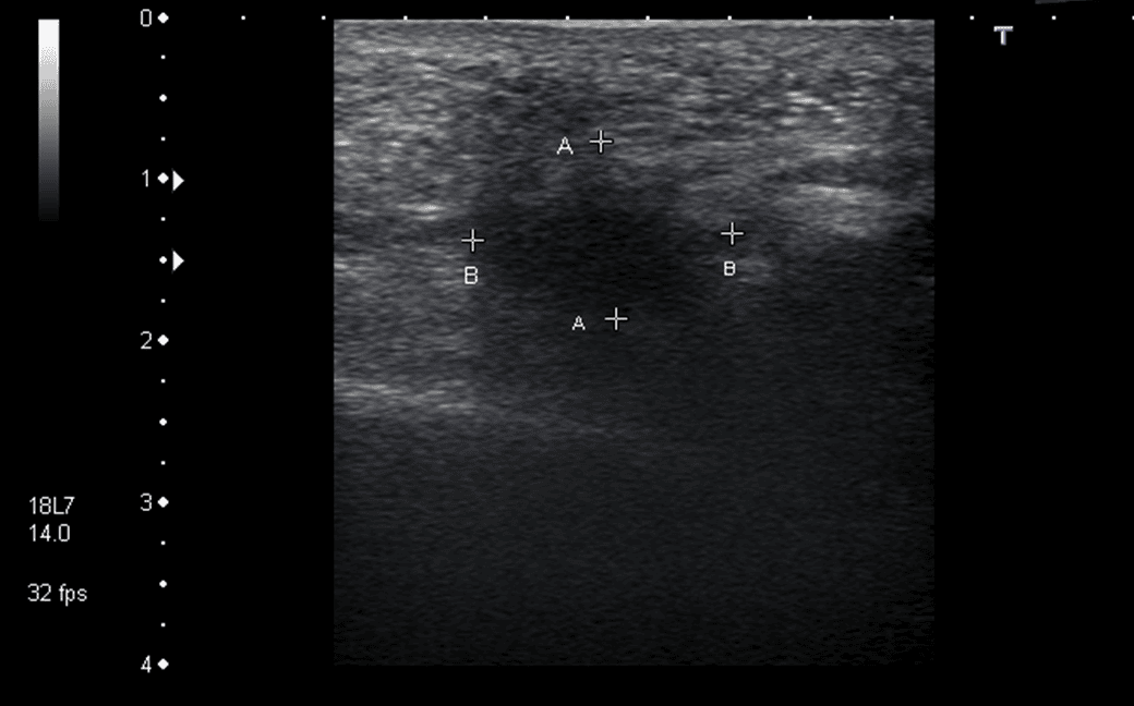 Ultrasound Images of Neuromas - Ankle, Foot and Orthotic Centre