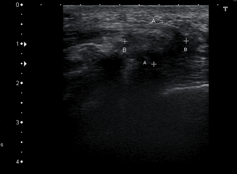 Bursal-Neuromal Complex vs Bursitis & Neuroma | AFOC