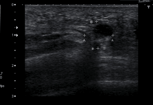 Bursal-Neuromal Complex vs Bursitis & Neuroma | AFOC
