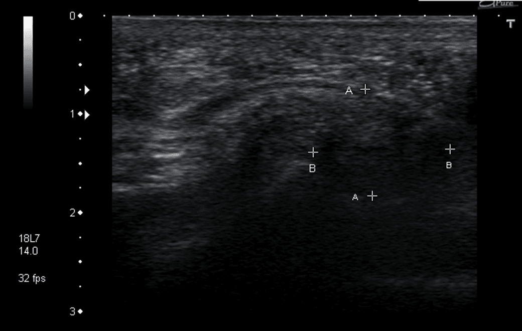 Clinical Ultrasound Imaging of Interdigital Neuromas