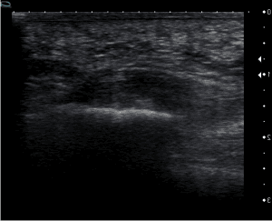 Tendon Fenestration - Ankle Foot and Orthotic Centre