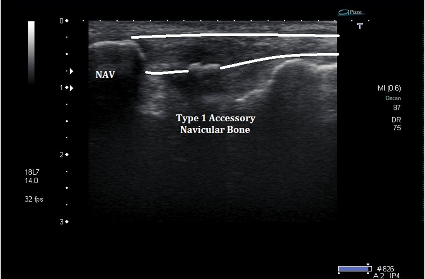 Ultrasound Imaging of the Accessory Navicular Bone | AFOC