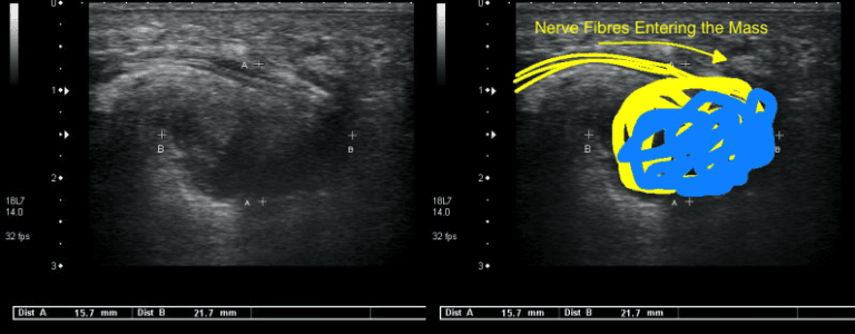 The 'Bursal - Neuromal Complex' (How does it differ from ...