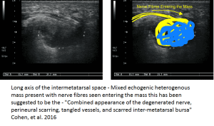 Bursal-Neuromal Complex vs Bursitis & Neuroma | AFOC