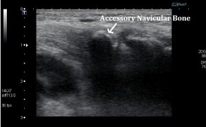Ultrasound Imaging of the Accessory Navicular Bone | AFOC