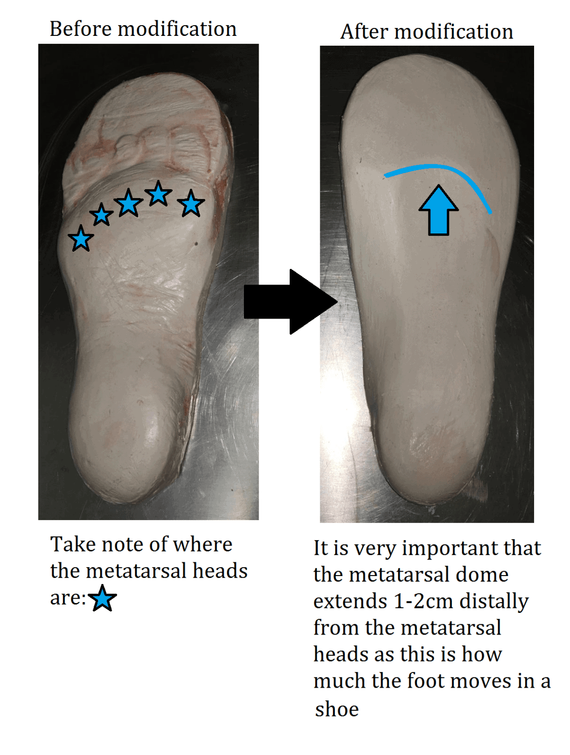 Bursal-Neuromal Complex vs Bursitis & Neuroma | AFOC