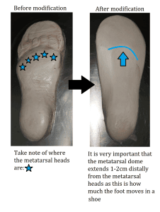 Bursal-Neuromal Complex vs Bursitis & Neuroma | AFOC