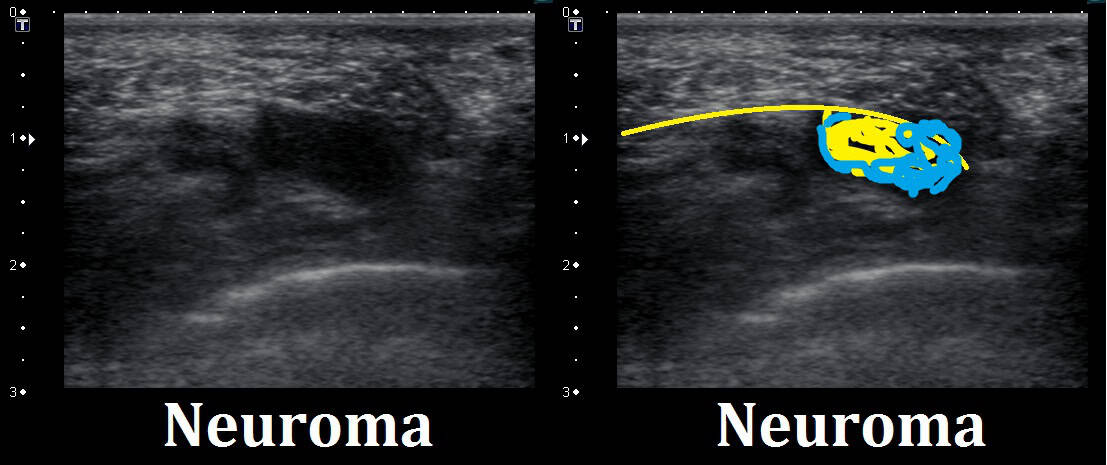 Ultrasound Images of Neuromas - Ankle, Foot and Orthotic Centre