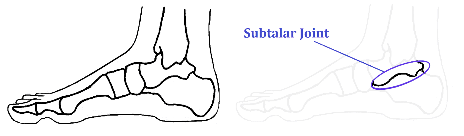 Subtalar Arthritis - Ankle Foot and Orthotic Centre
