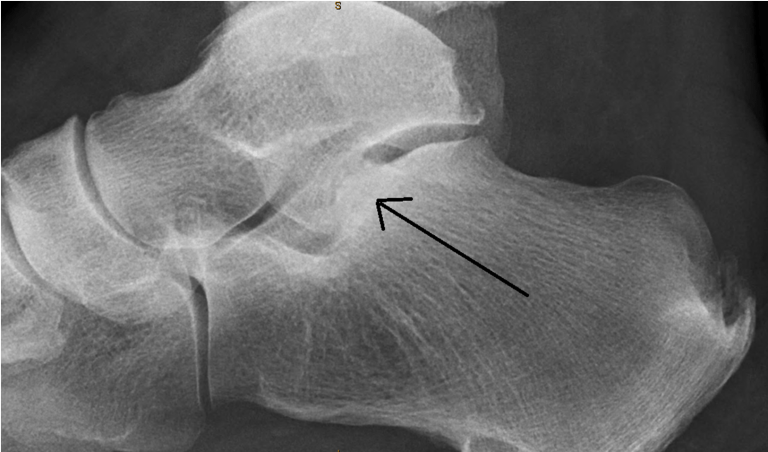 Subtalar Arthritis - Ankle Foot and Orthotic Centre