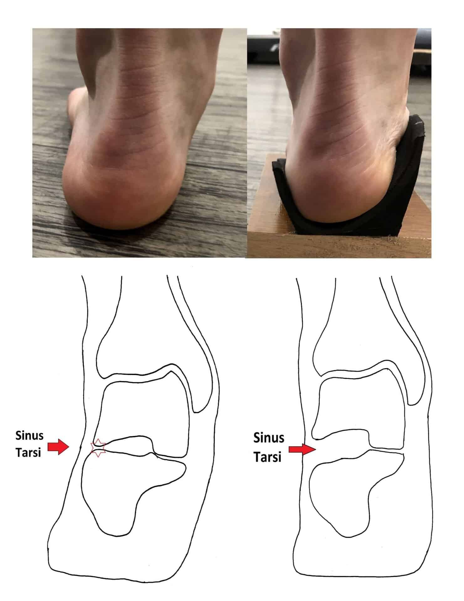 Sinus Tarsi Pain & Syndrome Treatment | AFOC