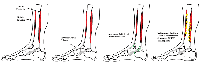 Shin Splints (Medial Tibial Stress Syndrome) - Ankle, Foot and Orthotic ...