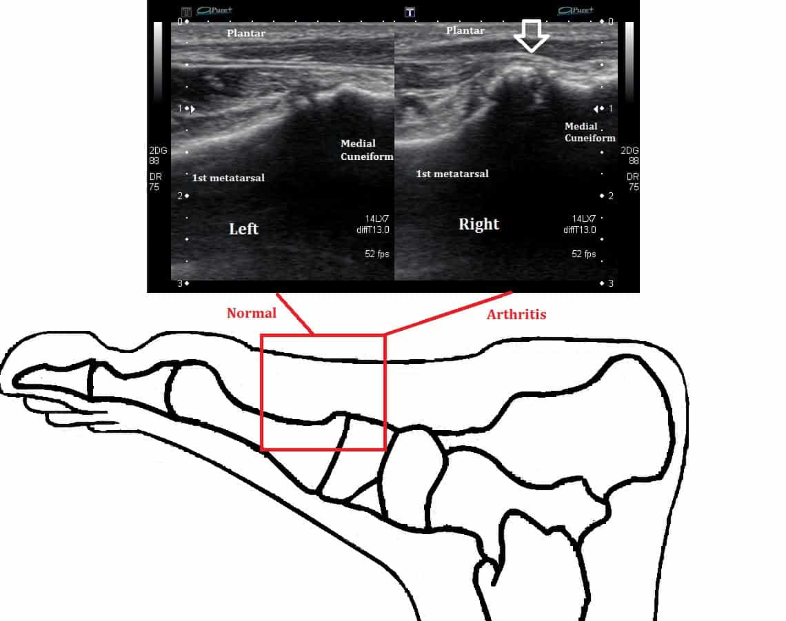 Midfoot Arthritis - Ankle Foot and Orthotic Centre