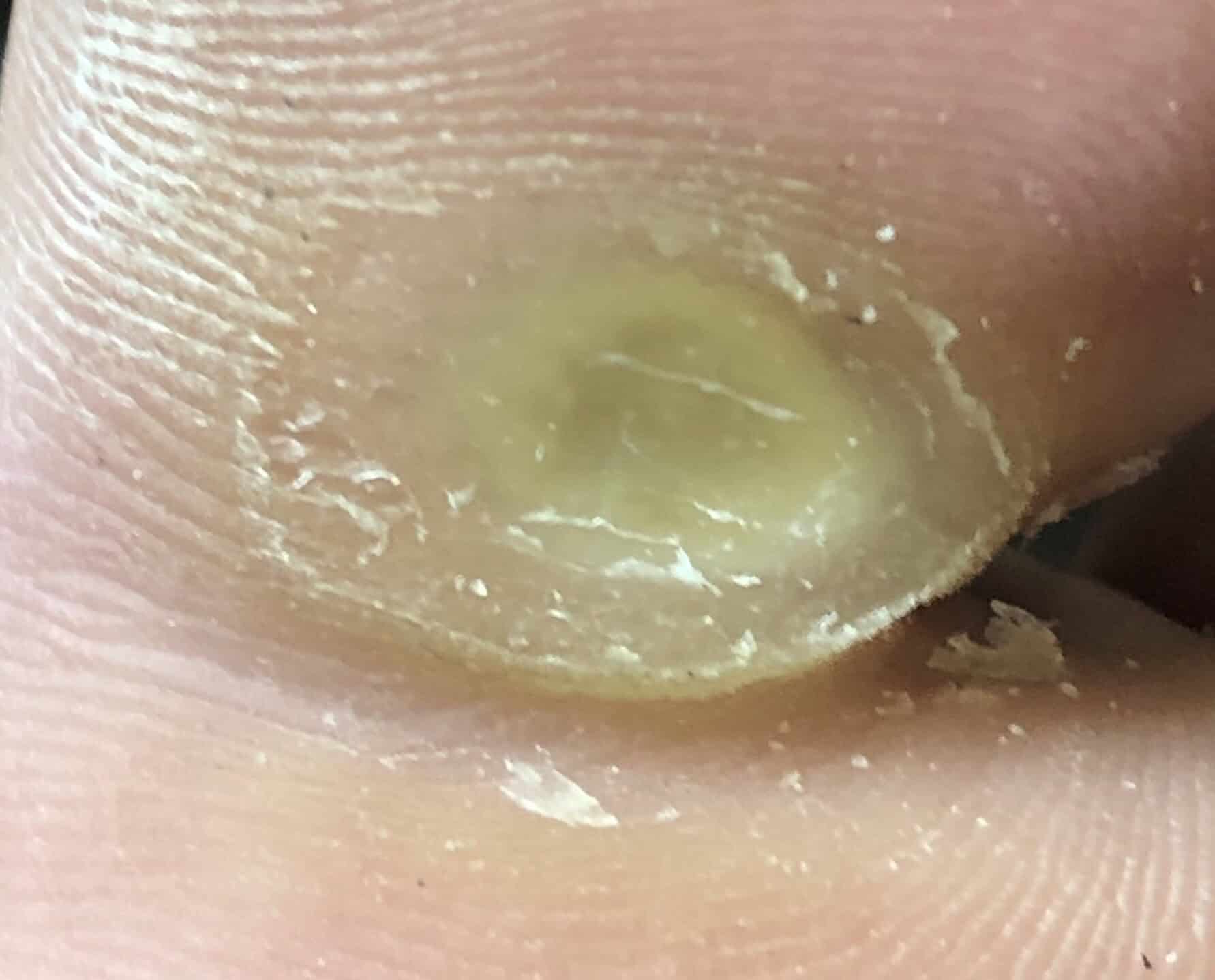 Smokers / Fibrous / Neurovascular corns (intractable plantar ...