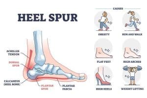 Heel Spurs - Ankle Foot and Orthotic Centre