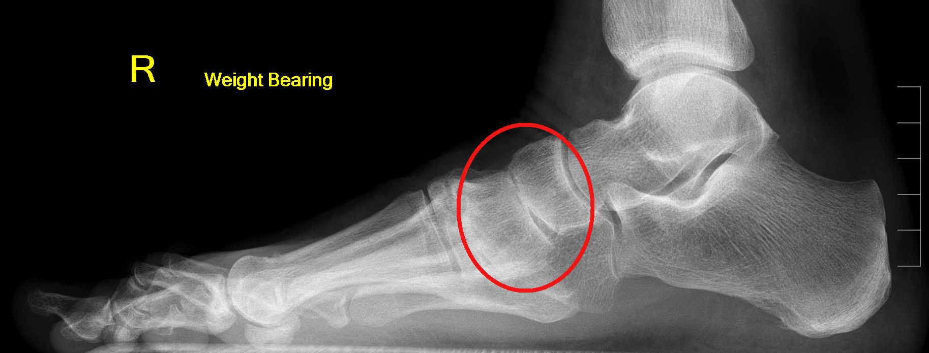 Arthritis - Ankle Foot and Orthotic Centre